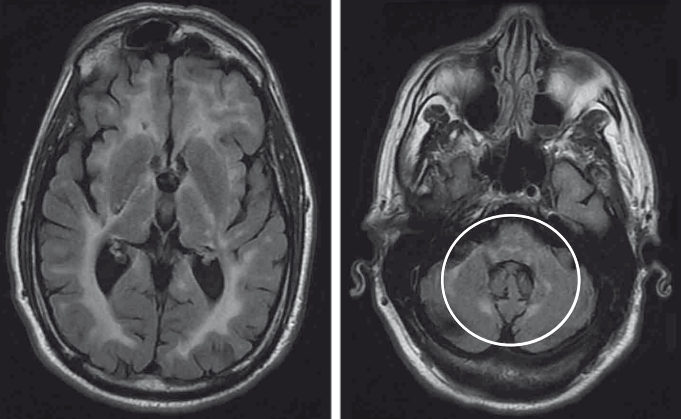 Progressive Weakness, Gait Issues, Memory Loss: What's Your Diagnosis ...