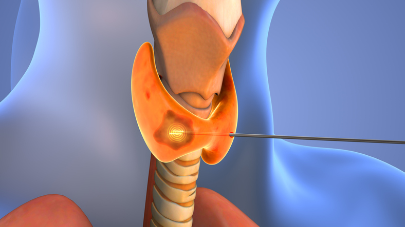 Indeterminate Thyroid Nodule Size May Predict RFA Success | Conexiant
